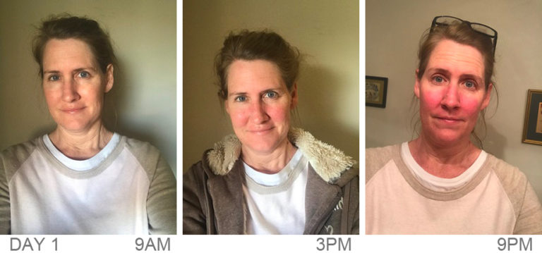 Tracey Clark | Using Picato For Skin With Sun Damage