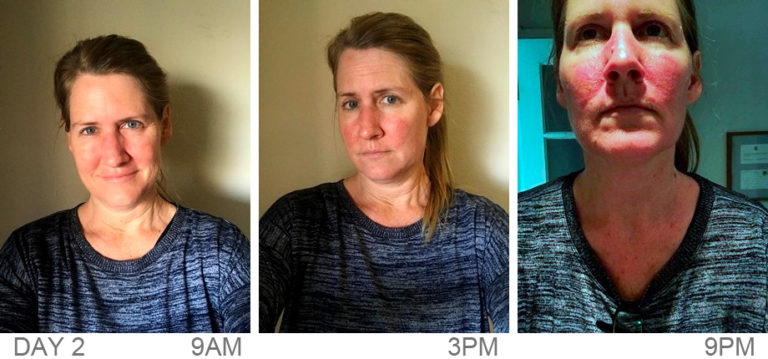 Tracey Clark | Using Picato For Skin With Sun Damage