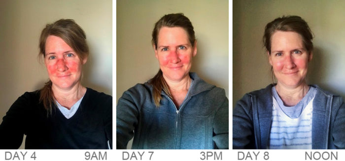 Tracey Clark | Using Picato For Skin With Sun Damage